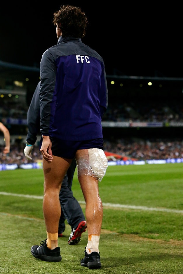 Predicting a hamstring injury: Can it be done?