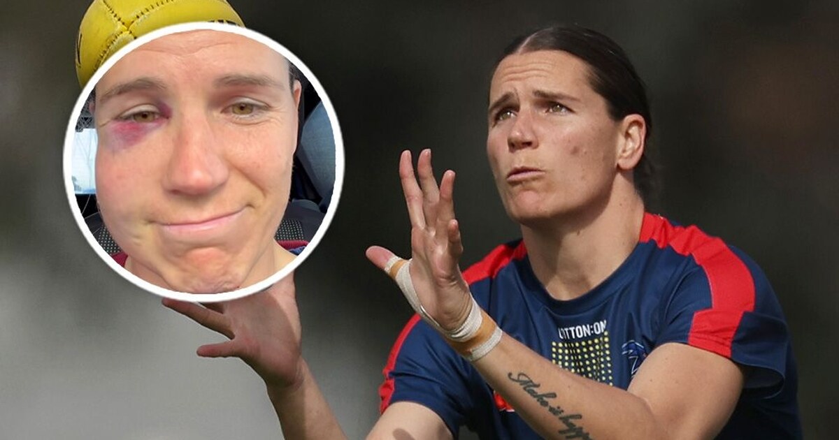 Ouch! Adelaide Crows star Chelsea Randall cleared of major damage ...